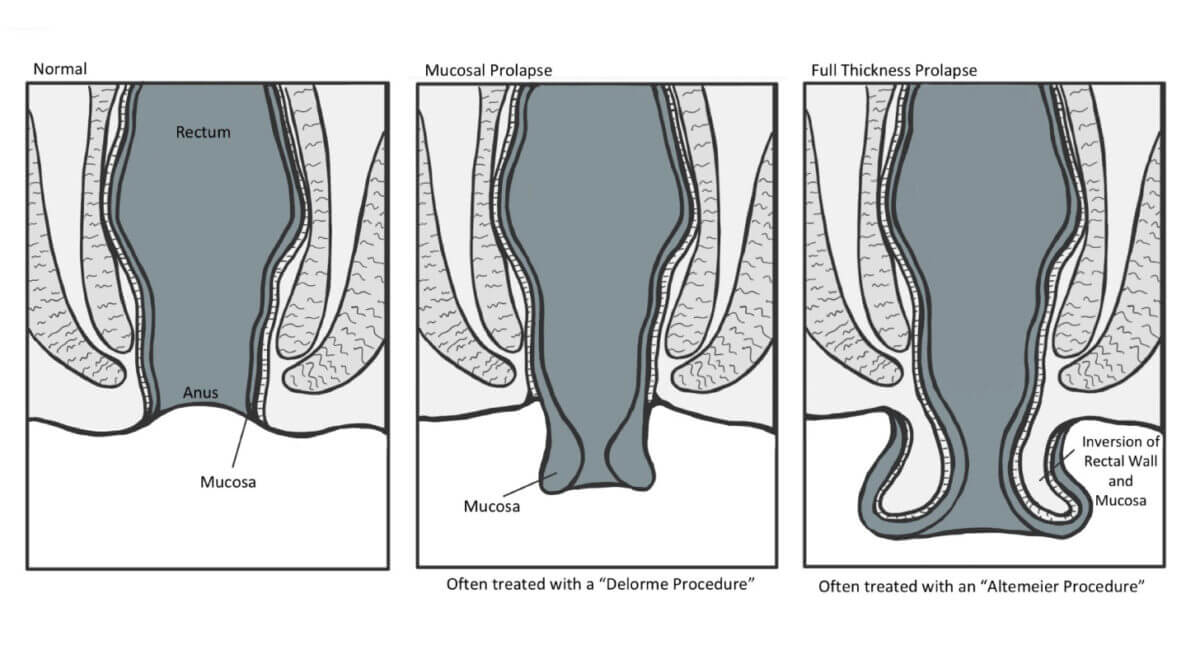 Rectal Prolapse Surgery From Top Laparoscopic Surgeon