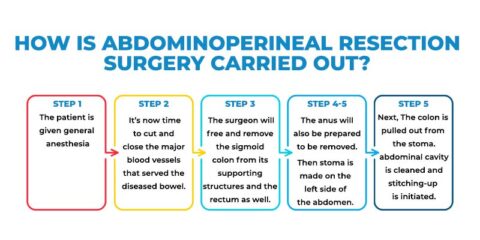 What Is Abdominoperineal Resection Surgery? | Rectal Cancer Surgery
